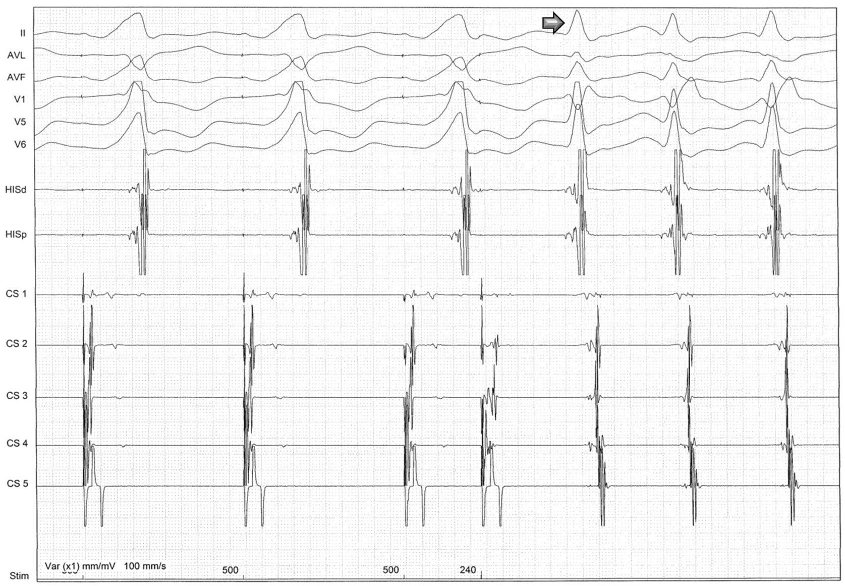 Iatrogenic ventricular fibrillation in Wolff-Parkinson-White syndrome ...