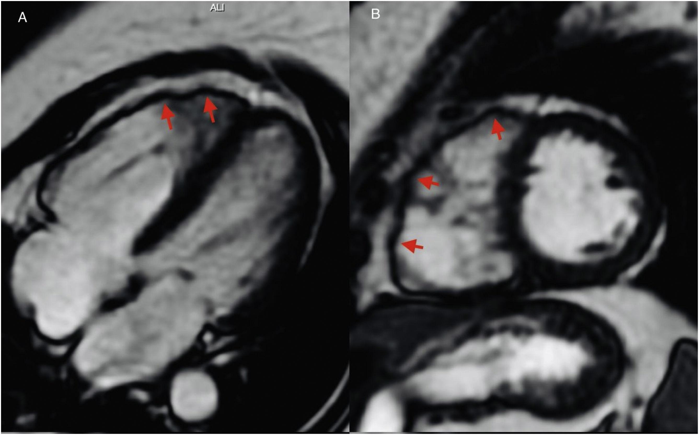 The uniqueness of cardiac magnetic resonance imaging in arrhythmogenic ...