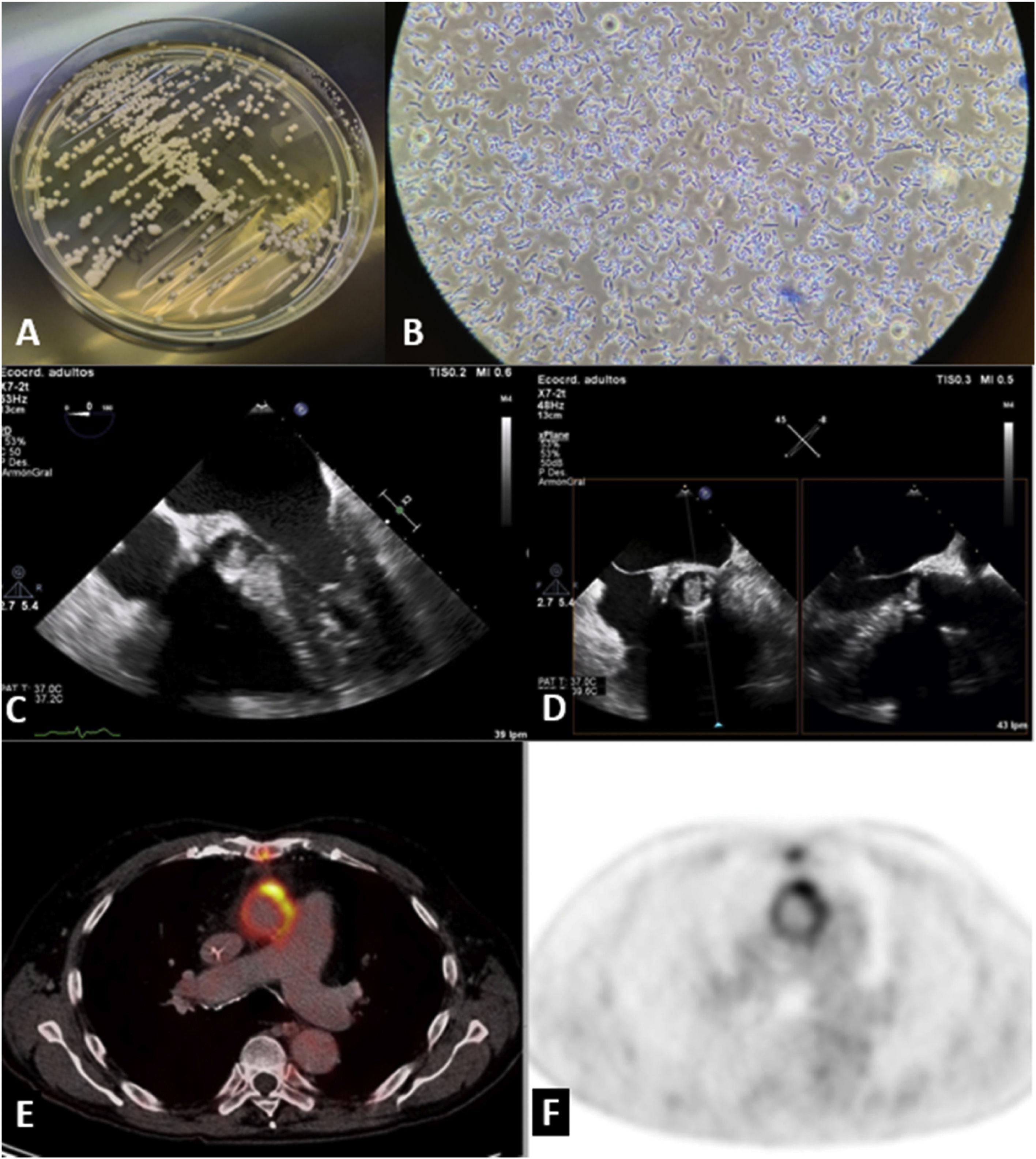Trichosporon inkin and recurrent infection of Bentall graft: A unique ...