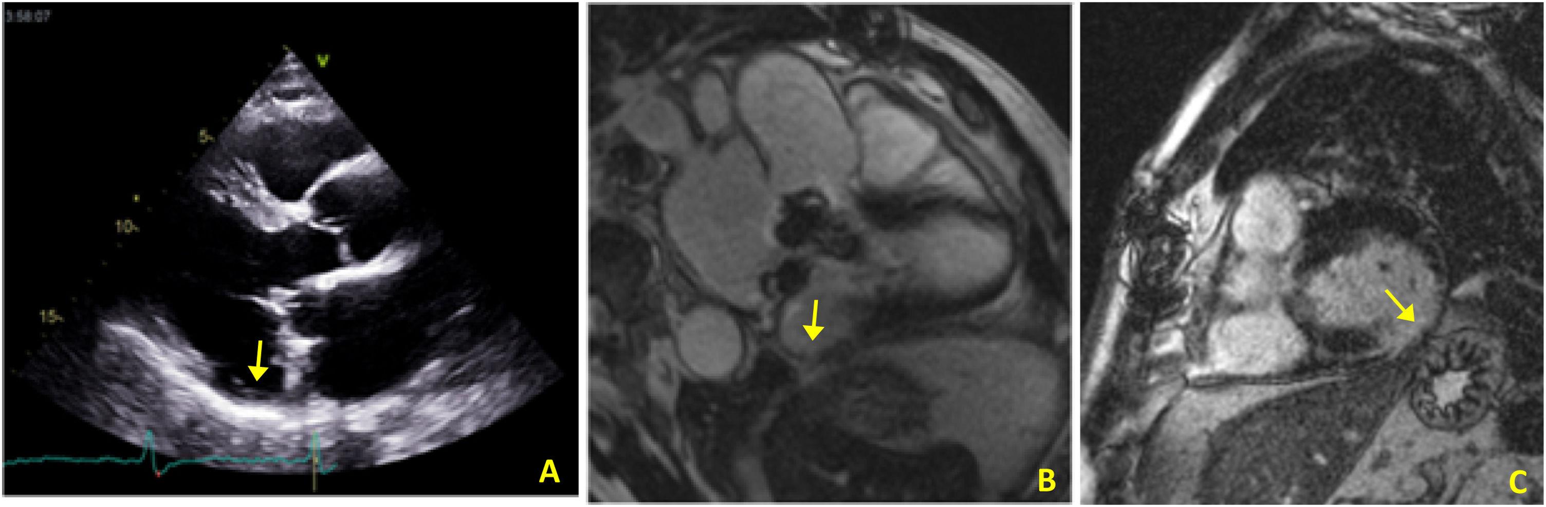 Mitral annular disjunction: Beyond mitral valve prolapse | Revista ...