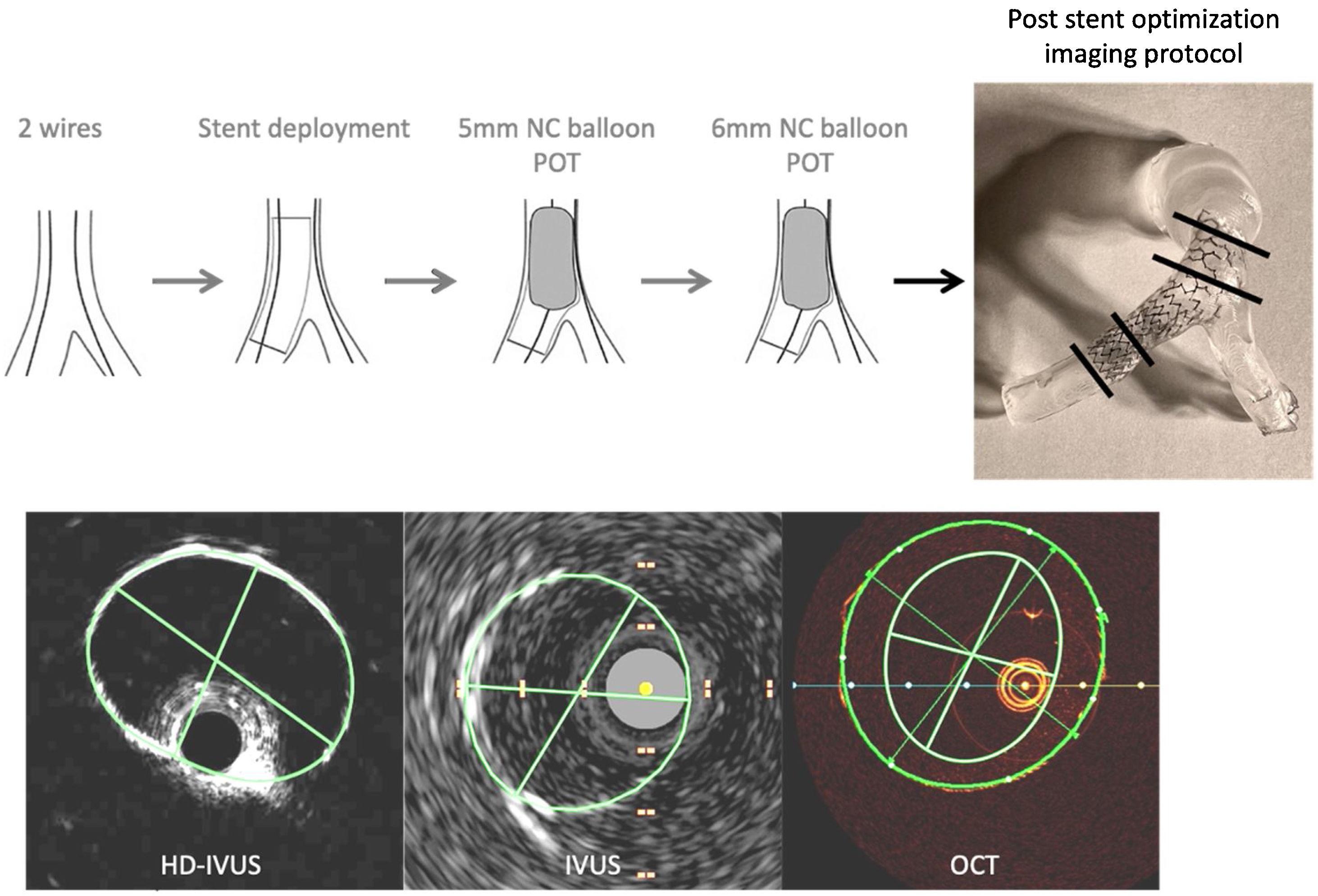 Intravascular imaging modalities in coronary intervention: Insights ...