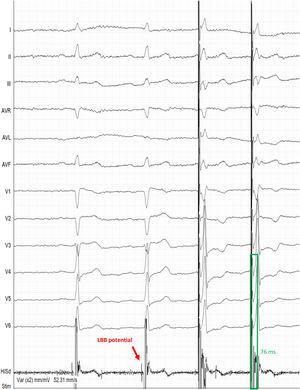His bundle pacing and left bundle branch area pacing: Feasibility and ...