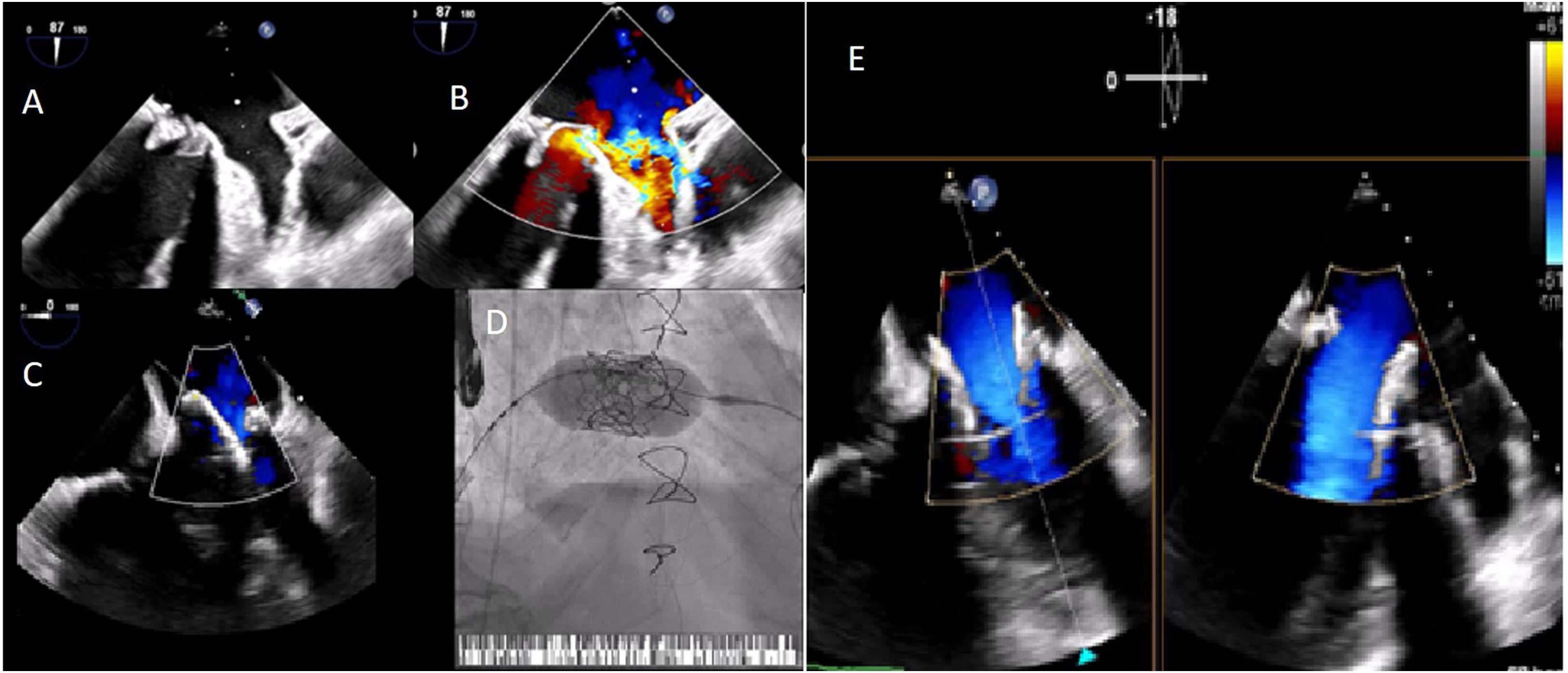 Percutaneous implantation of a Sapiens 3 valve-in-valve in mitral ...