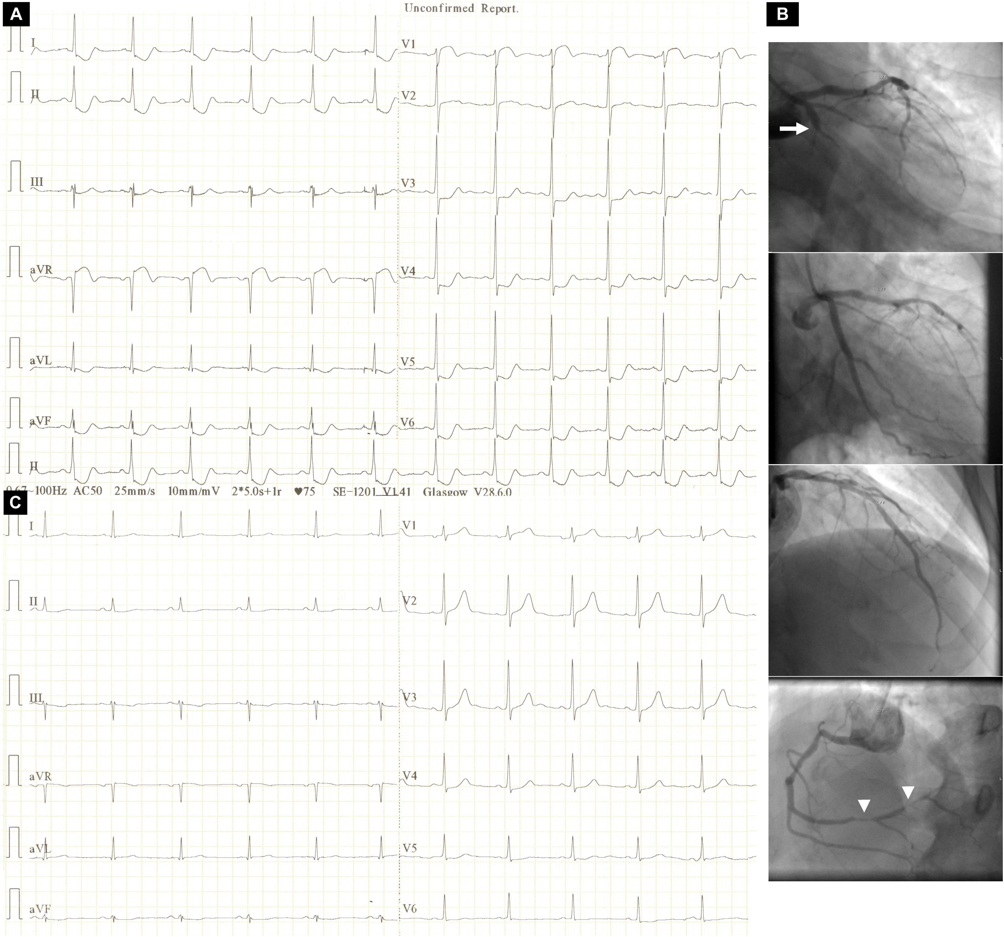 Uncommon electrocardiographic presentation of acute left circumflex ...