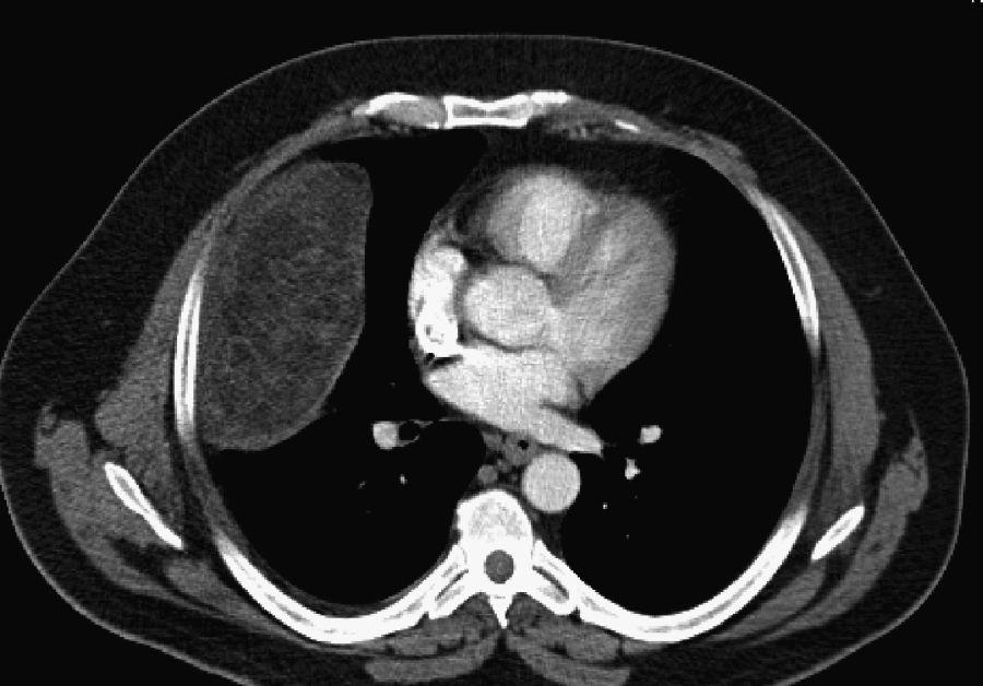 A massive pleural-based tumour: The challenge of diagnosis | Pulmonology