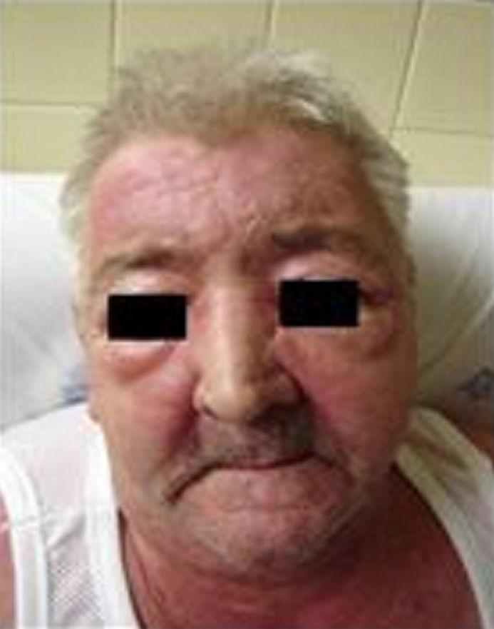 Dermatomiosite como primeira manifestação de uma neoplasia pulmonar ...