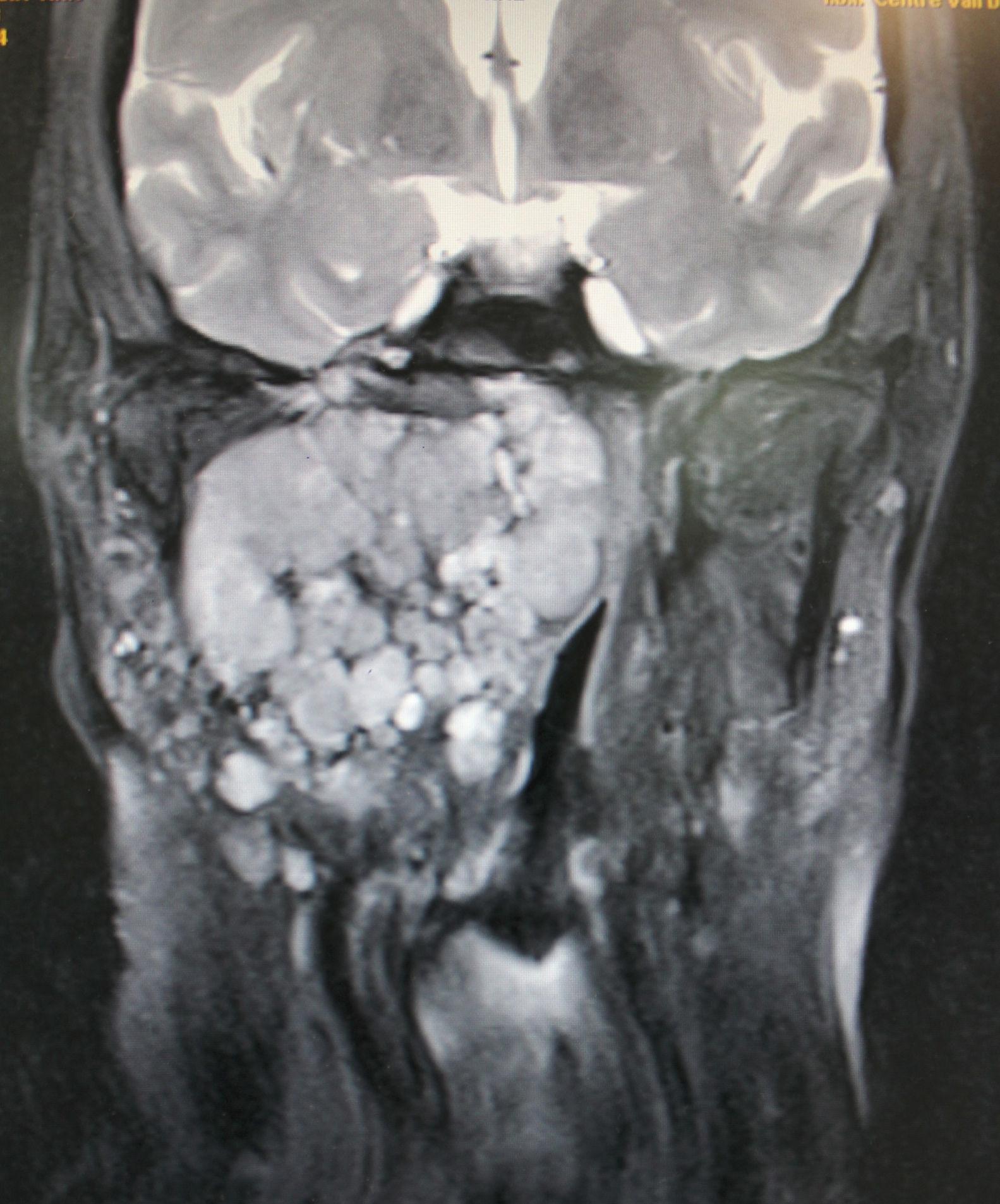 ¿Cuál es su abordaje? | Revista Española de Cirugía Oral y Maxilofacial