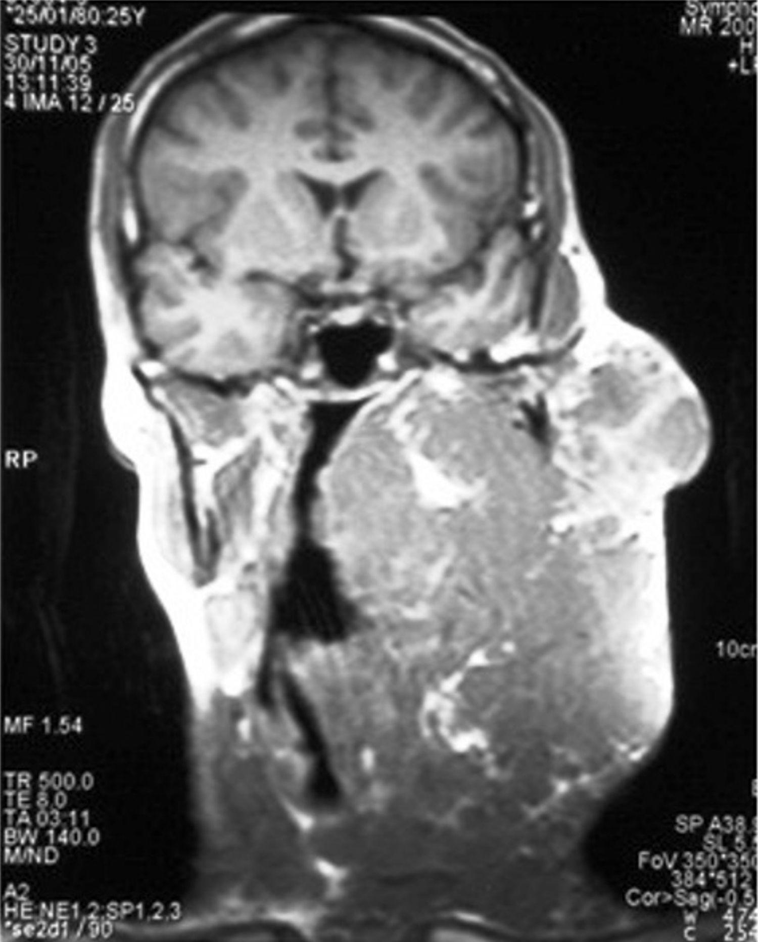 Angioma facial congénito no involutivo | Revista Española de Cirugía ...