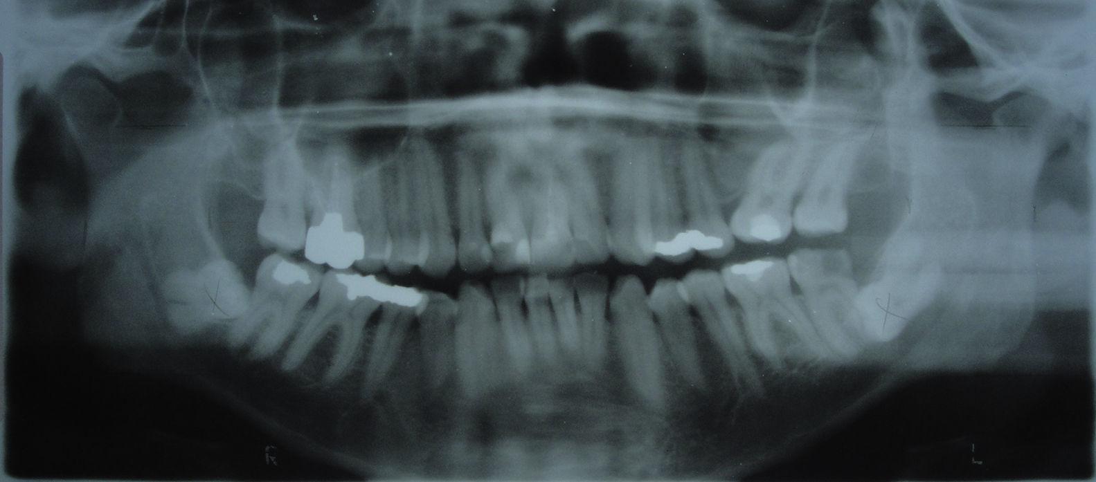 Hiperplasia de procesos coronoideos mandibulares: un nuevo tratamiento ...