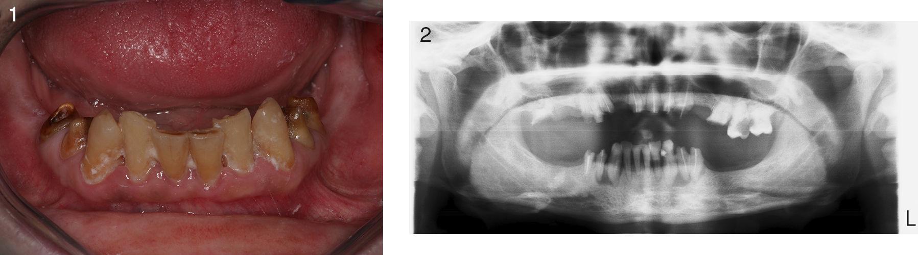 Carga inmediata de implantes monofásicos postextracción utilizando los ...