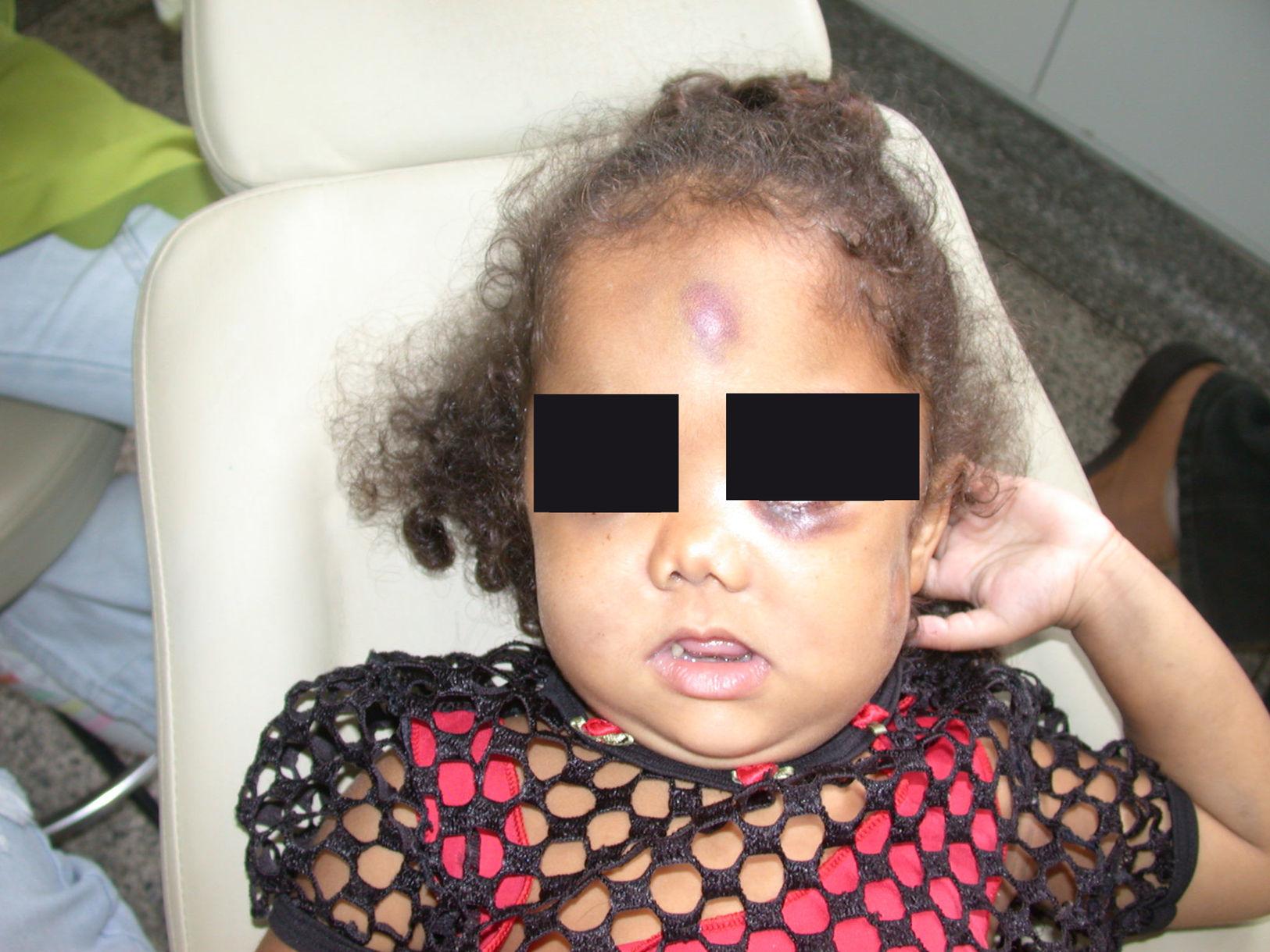 Osteomyelitis of the maxilla in a patient with Malignant Infantile ...