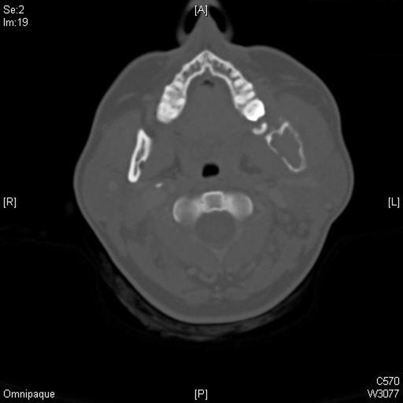 Diagnóstico de mieloma múltiple a raíz de una lesión osteolítica ...