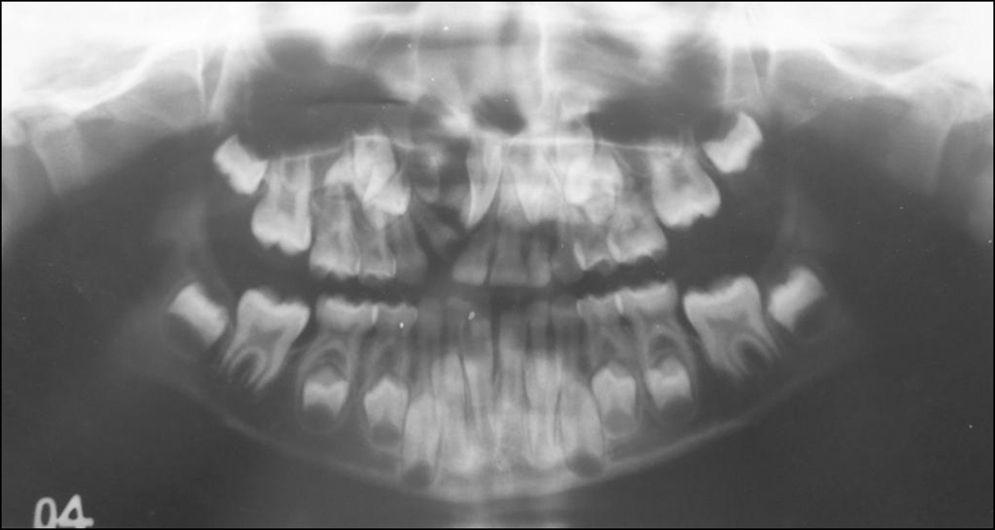 Prevalencia de dientes supernumerarios en pacientes con labio y paladar ...