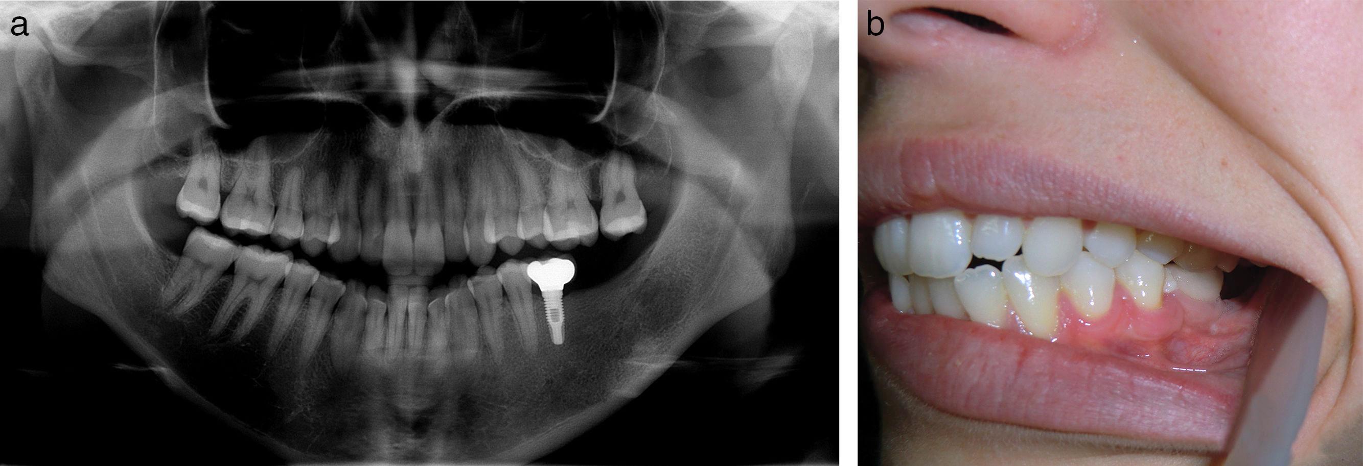 Mixoma odontogénico: presentación de una serie de 4 casos clínicos y ...