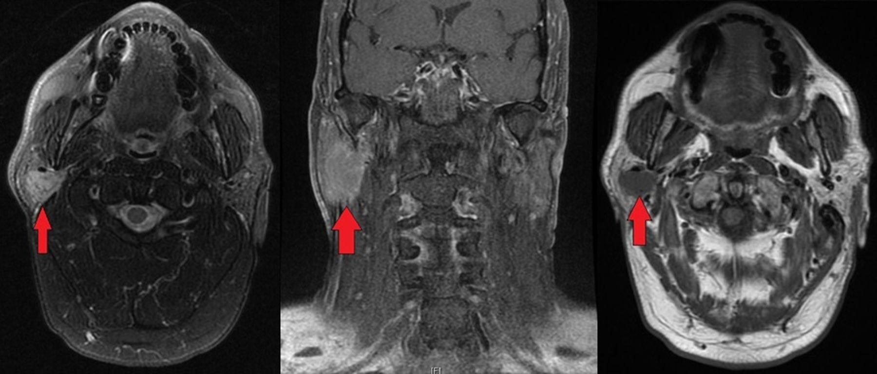 Linfoma de la zona marginal de glándula parótida | Revista Española de ...