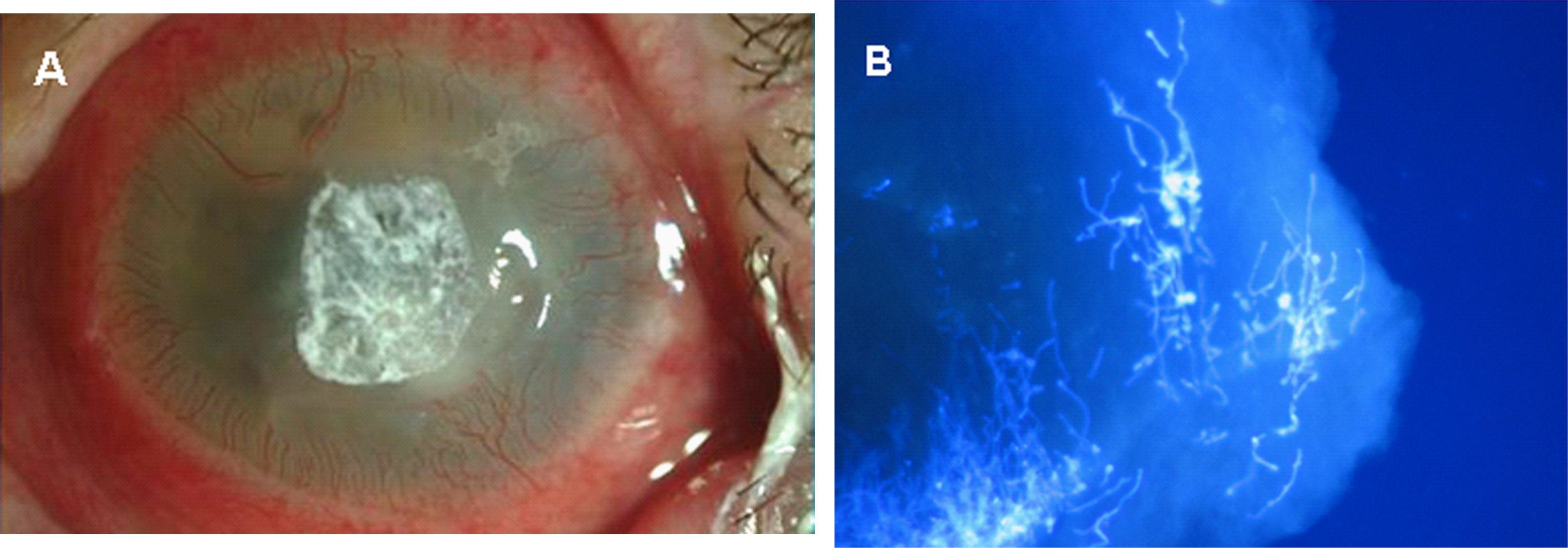 Pyrenochaeta keratinophila sp. nov., isolated from an ocular infection ...