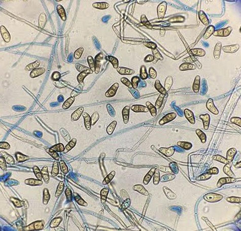 Queratitis fúngica por Curvularia hominis: primer caso descrito en ...