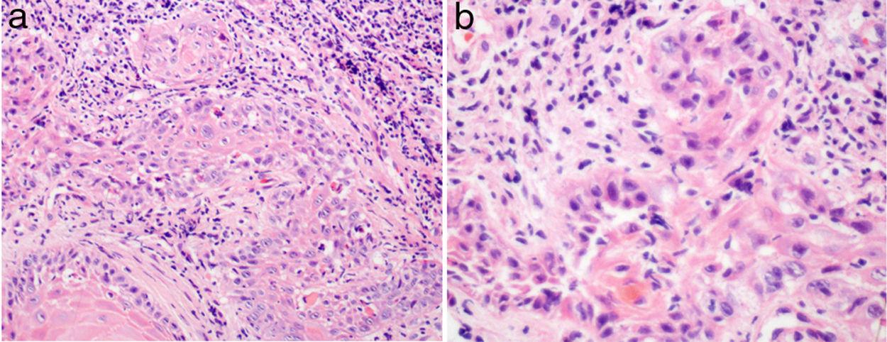 Sporothrix Schenckii Histology