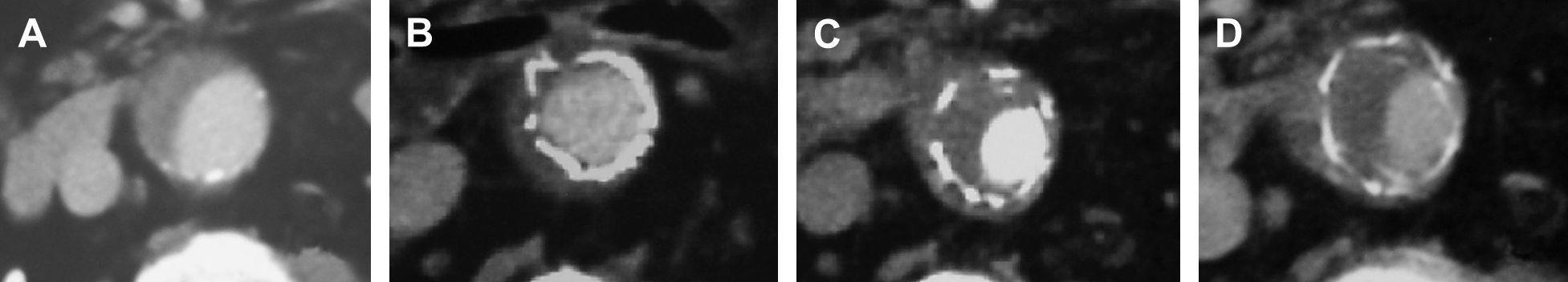 Incidencia y evolución del trombo mural en endoprótesis aórticas ...