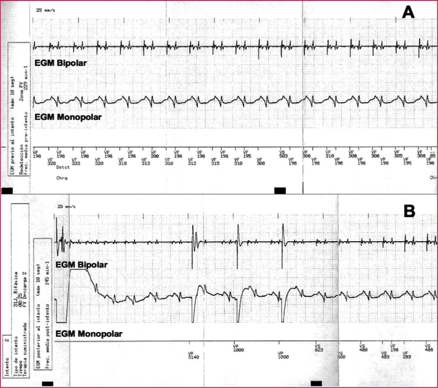 Utilidad diagnóstica de los electrogramas almacenados por el ...