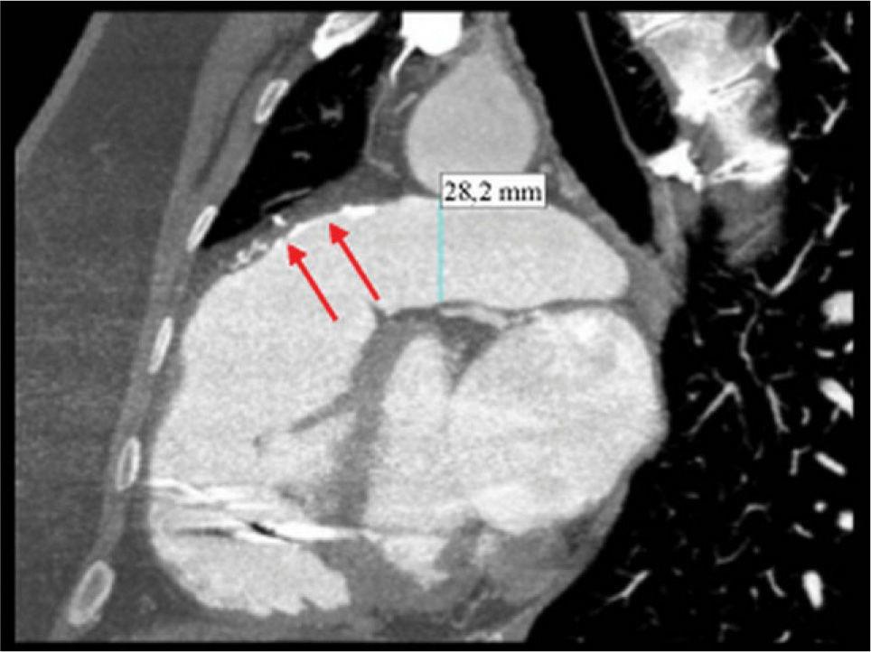Cardiopatías congénitas por resonancia magnética y tomografía ...