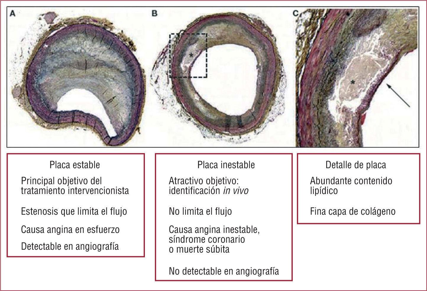 Angina crónica estable: fisiopatología y formas de manifestación ...