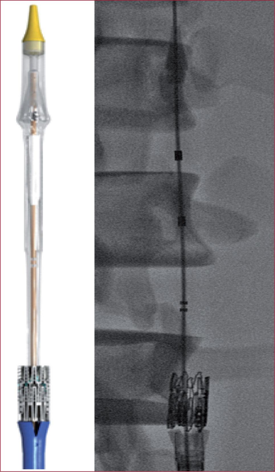 Implantación transcatéter de prótesis valvular aórtica (situación ...