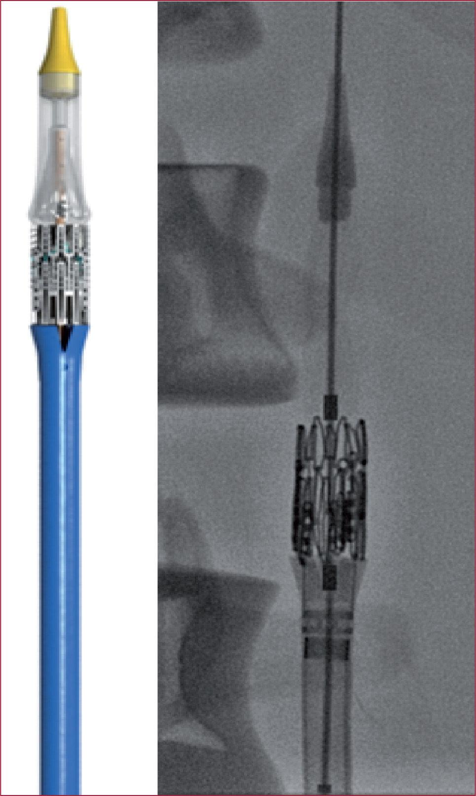 Implantación transcatéter de prótesis valvular aórtica (situación ...