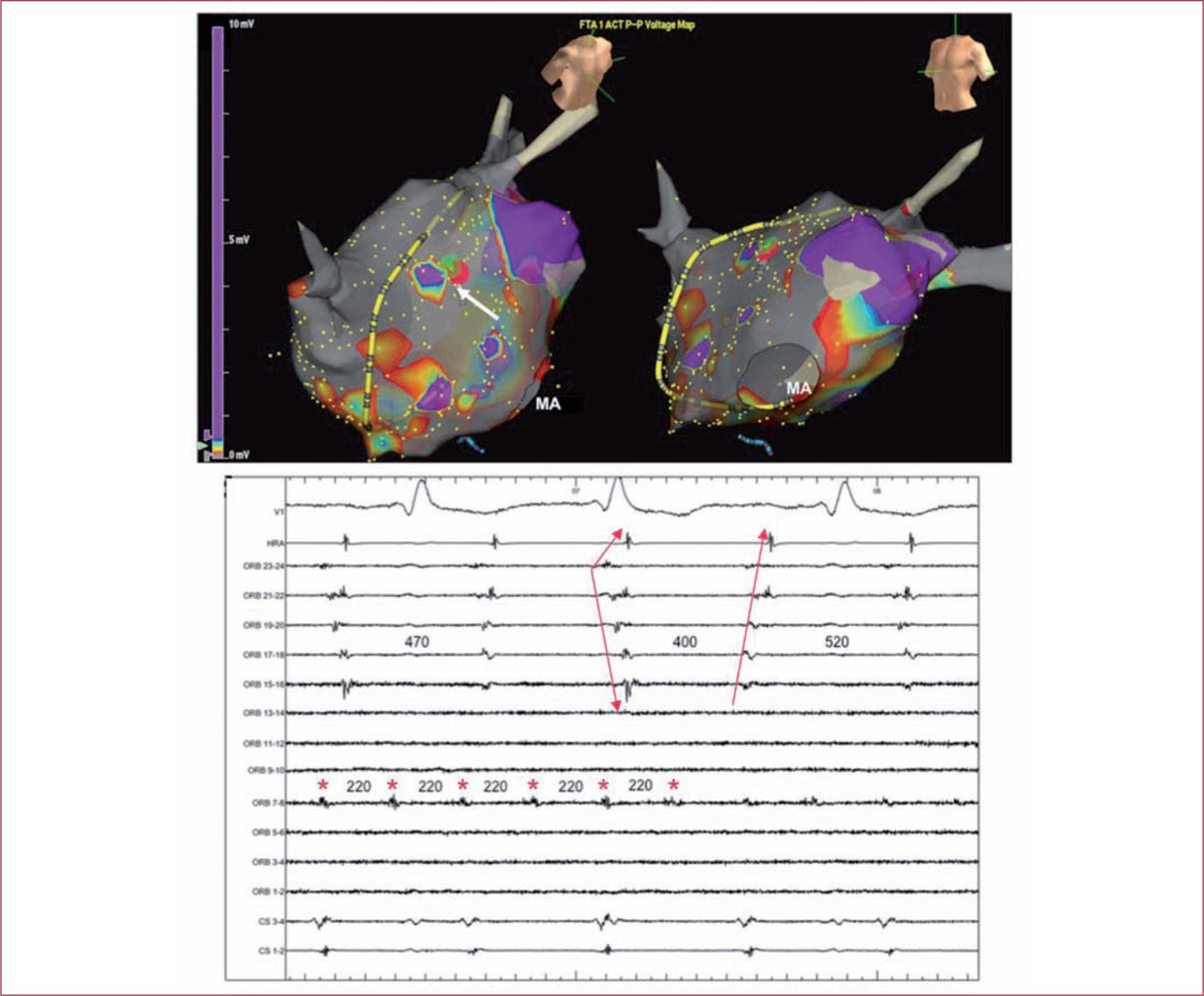 Mecanismos electrofisiológicos y diagnóstico de la fibrilación ...