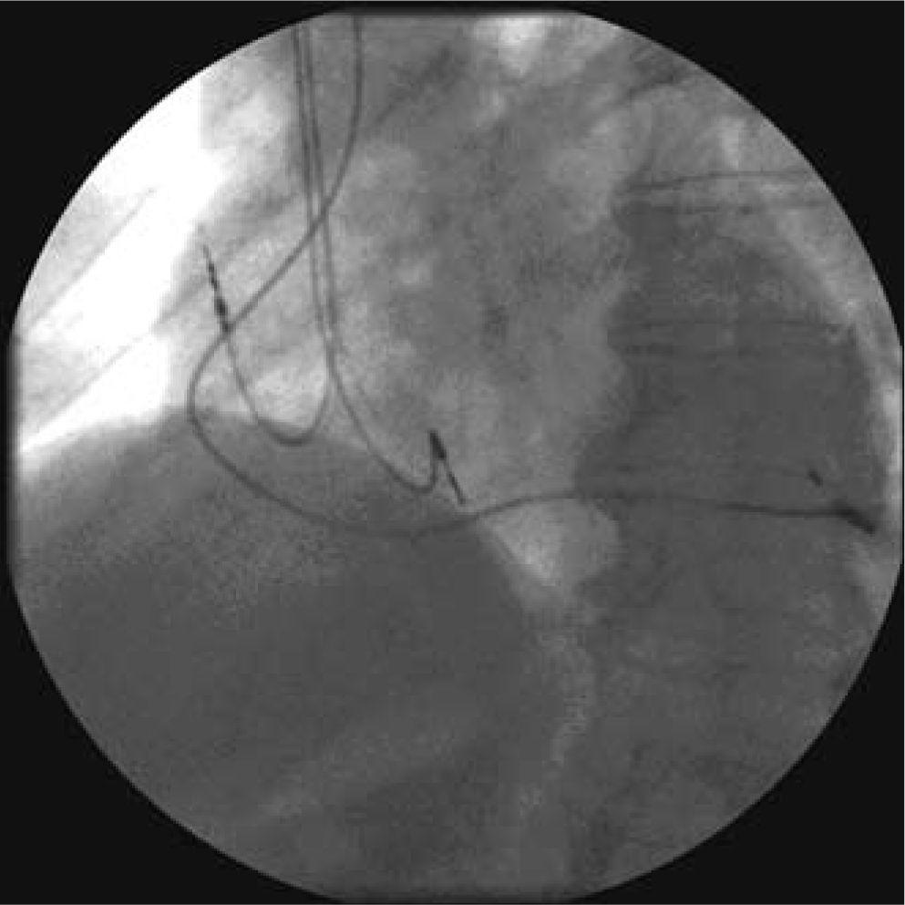 Terapia de resincronización en la insuficiencia cardíaca | Cirugía ...
