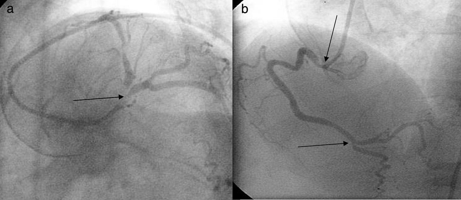 Enfermedad coronaria multivasos en un paciente con aorta de porcelana ...