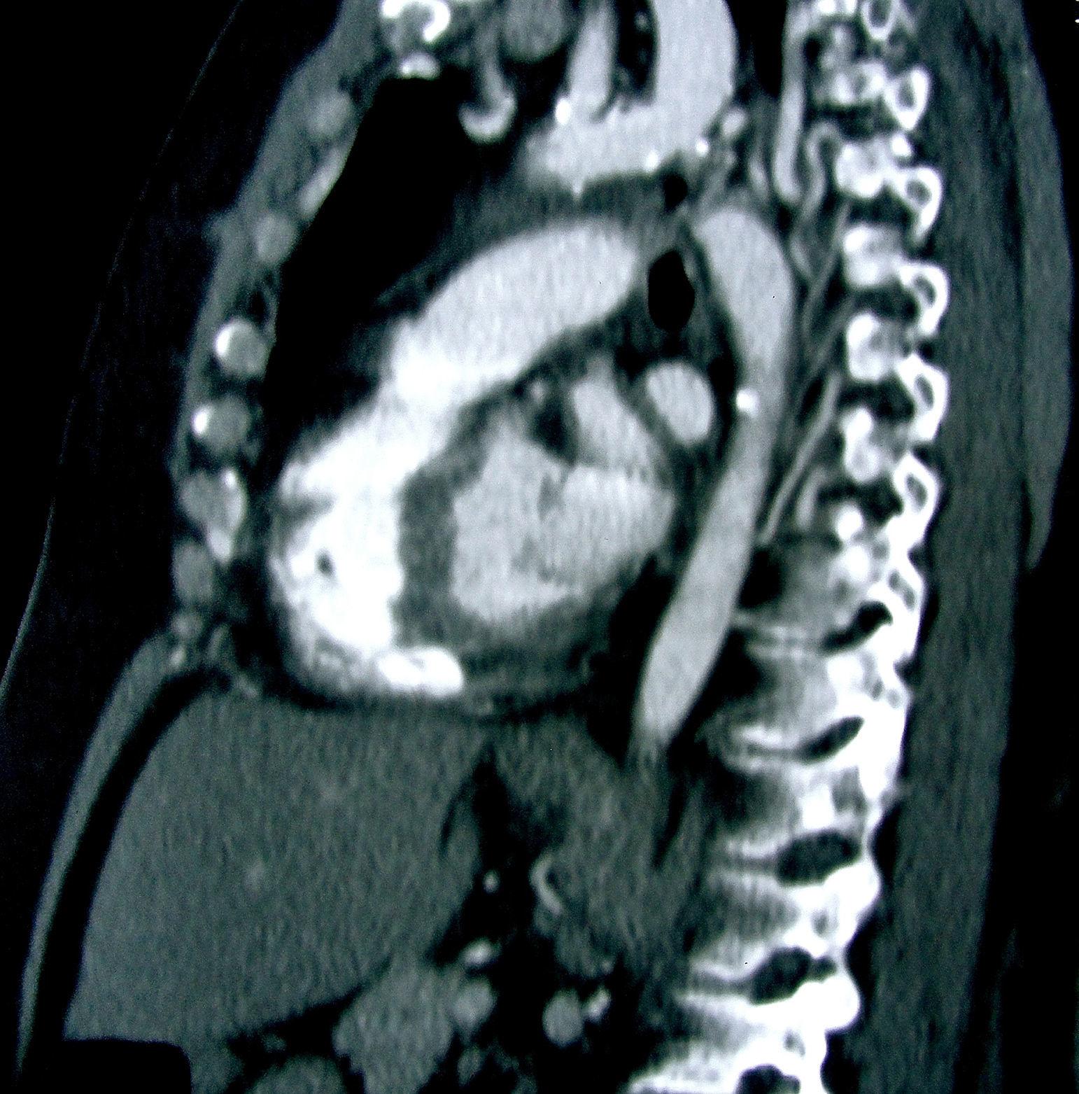 Cirugía inusual en un caso de coartación aórtica | Cirugía Cardiovascular