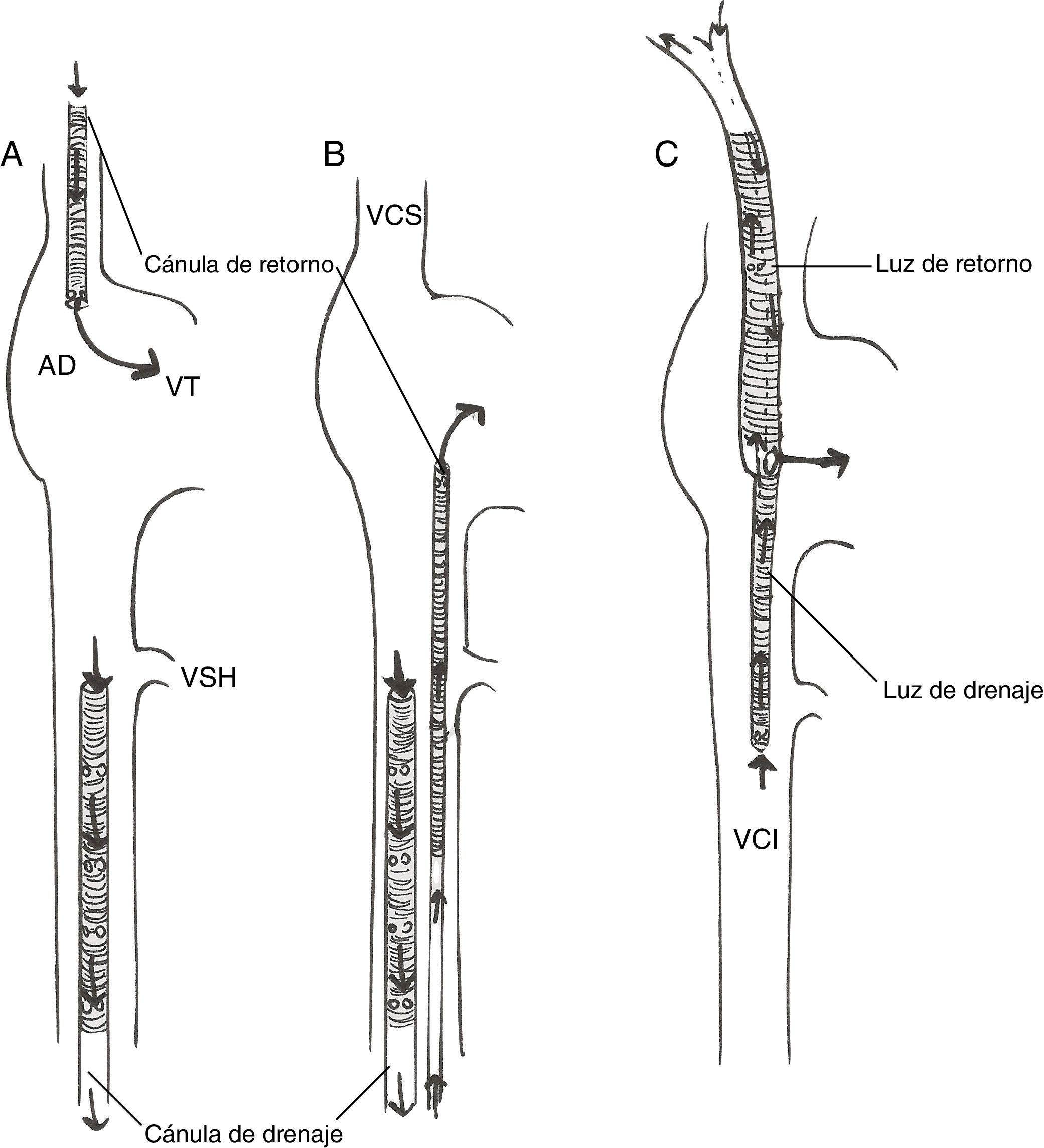 Asistencia mecánica circulatoria de corta duración | Cirugía Cardiovascular