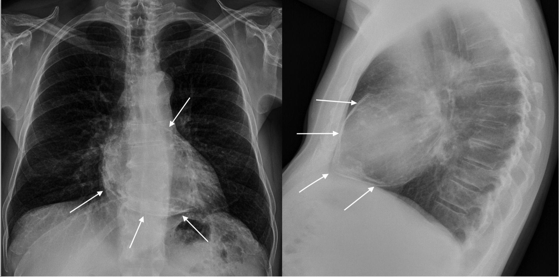 Pericarditis constrictiva calcificada: una presentación inicial ...