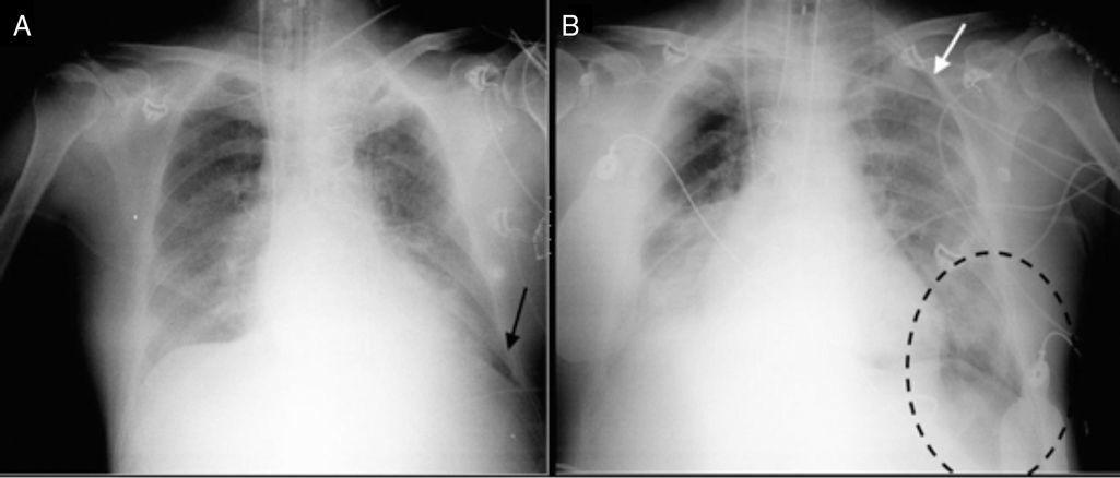«Surco costofrénico profundo» en paciente con trasplante cardiaco ...