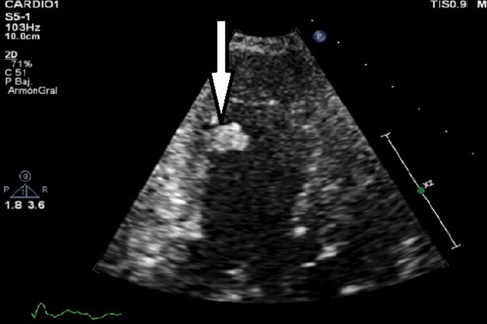 Un caso infrecuente de fibroelastoma papilar | Cirugía Cardiovascular