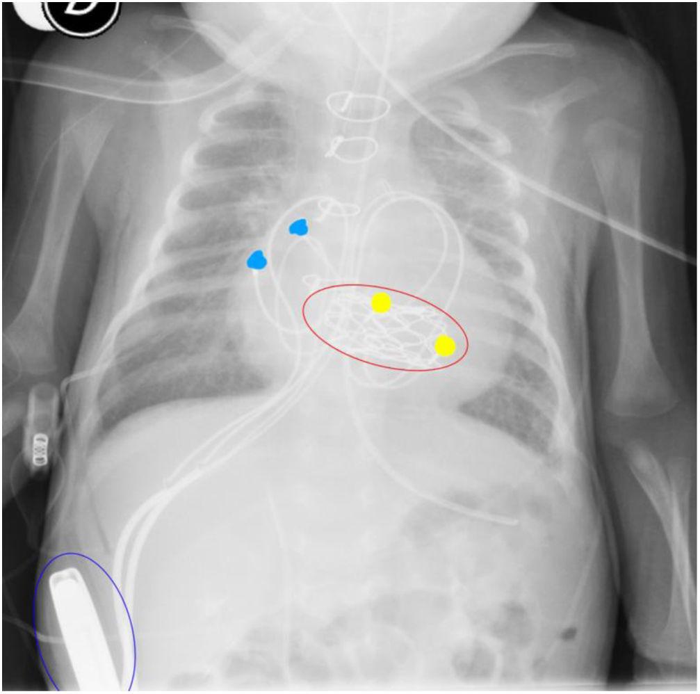 Procedimiento de Ross-Konno más reemplazo valvular mitral neonatal tras ...