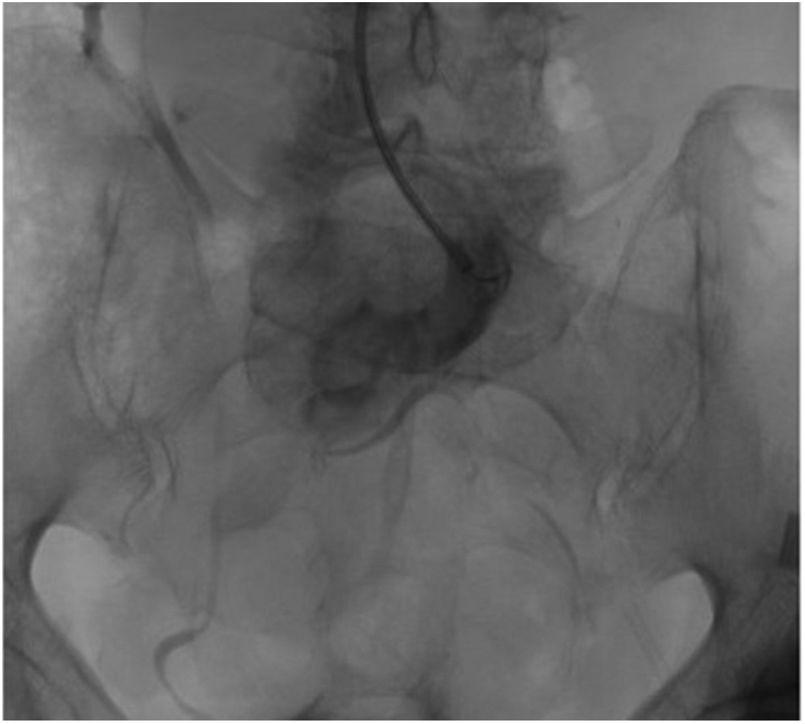 Chimney/snorkel endovascular aneurysm repair (ChEVAR) of an abdominal ...