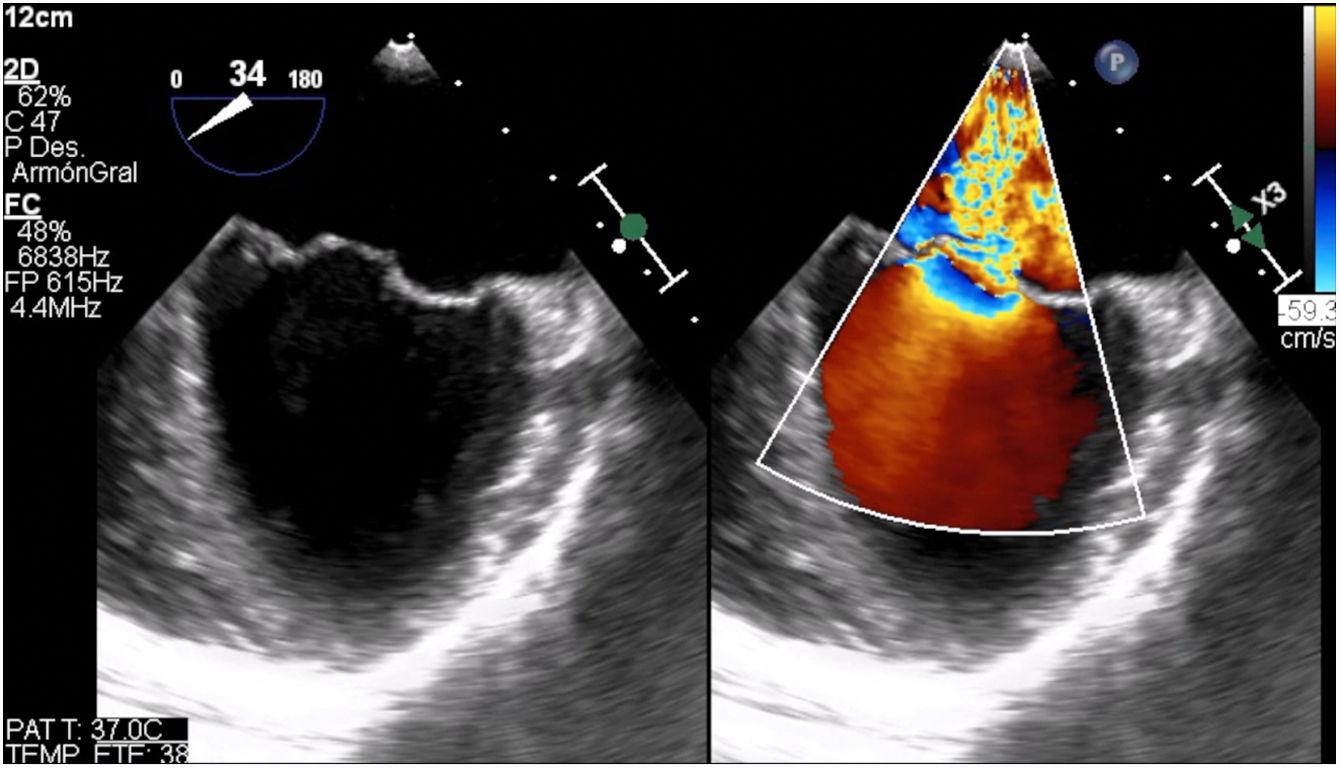 Isolated congenital mitral leaflet perforation in a young adult: A case ...