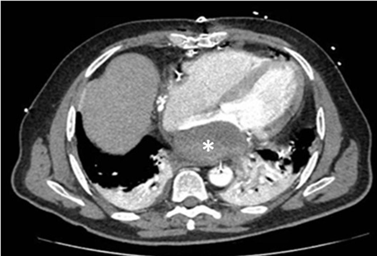 Left atrial wall dissection after on-pump coronary surgery | Cirugía ...