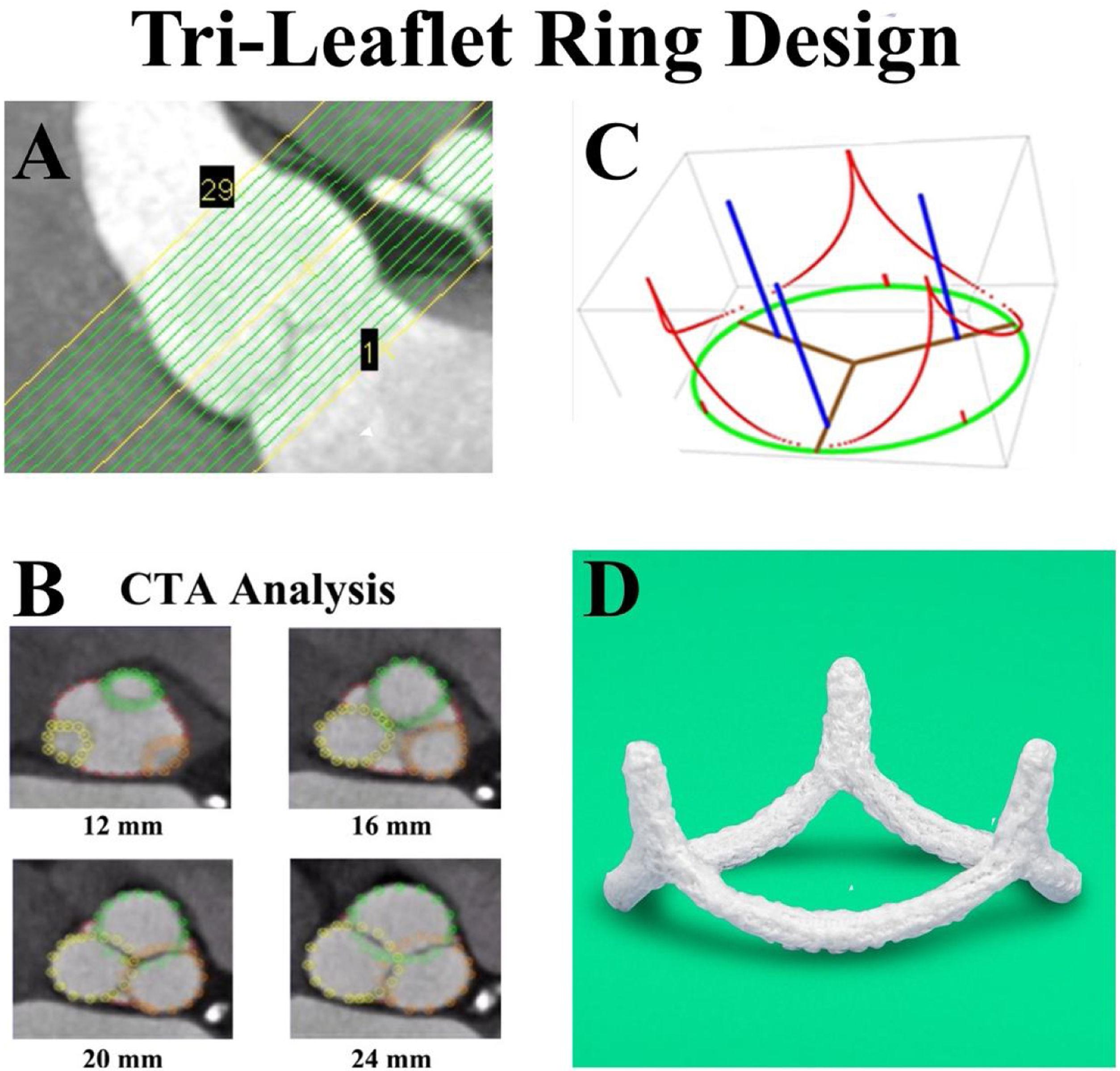 Aortic valve repair using geometric ring annuloplasty | Cirugía ...