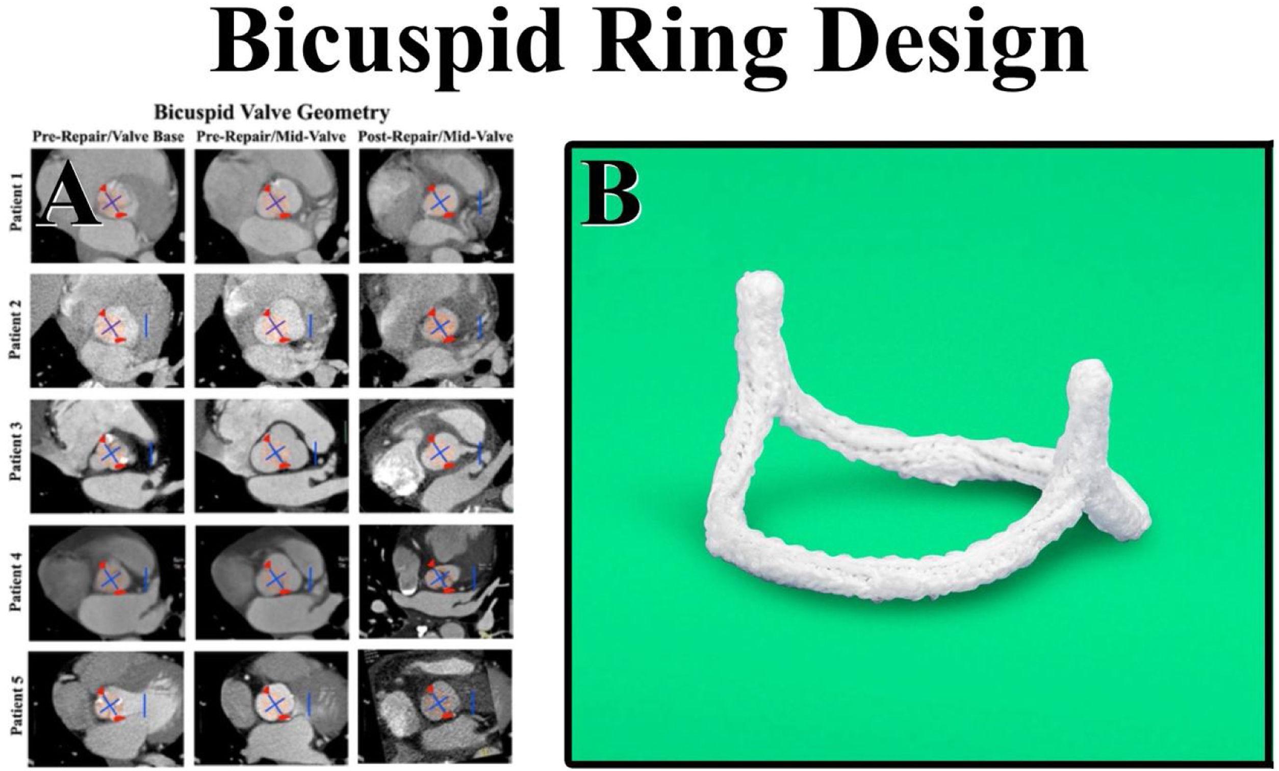 Aortic valve repair using geometric ring annuloplasty | Cirugía ...