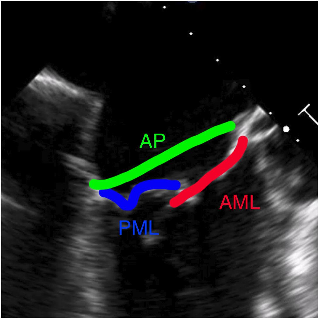 Reparación de la válvula mitral sin circulación extracorpórea con ...