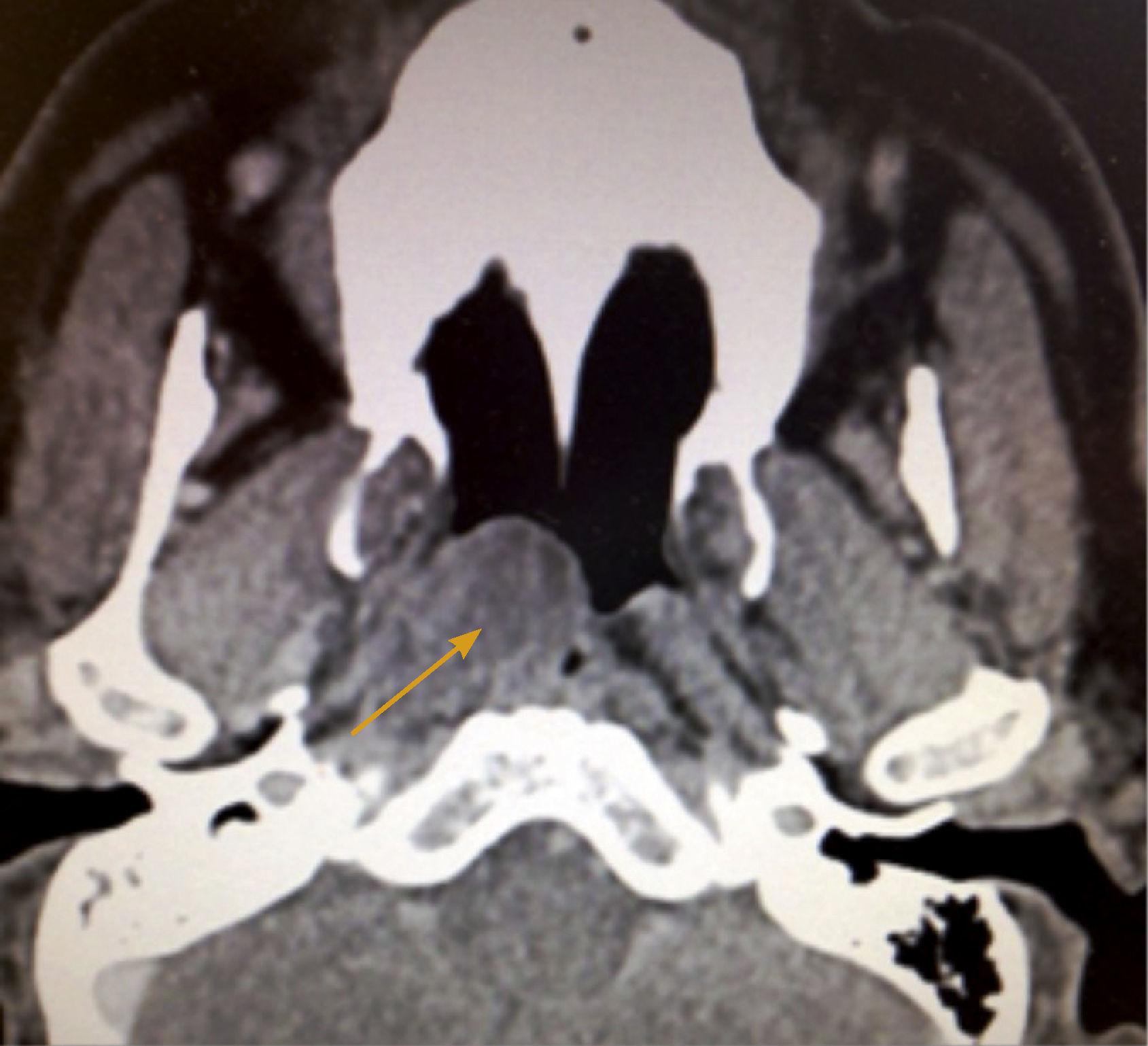 Desde hace 2 meses noto mi oído derecho taponado | FMC. Formación ...