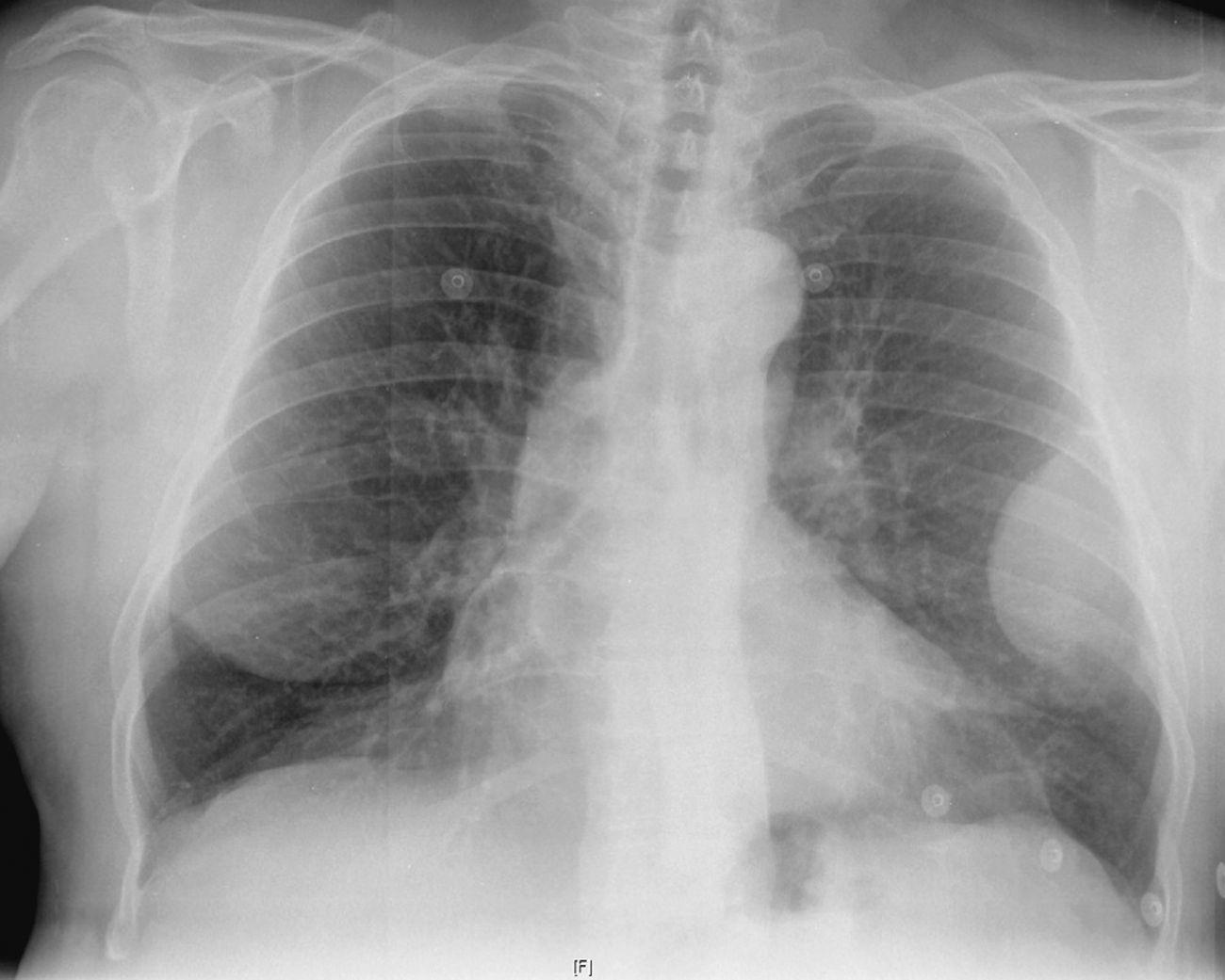 Signo radiológico de la «embarazada» | Medicina de Familia. SEMERGEN