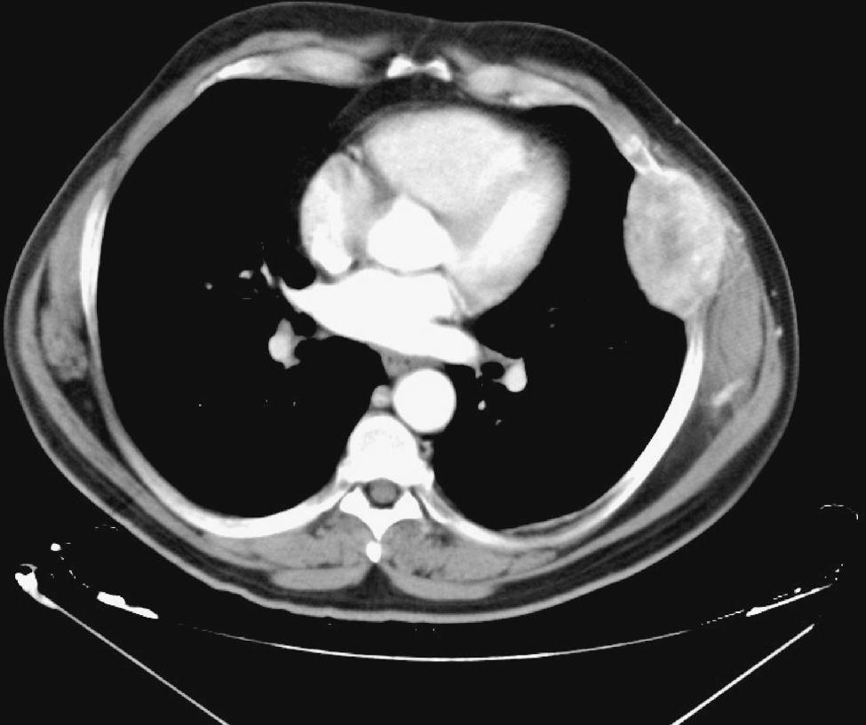 Signo radiológico de la «embarazada» | Medicina de Familia. SEMERGEN