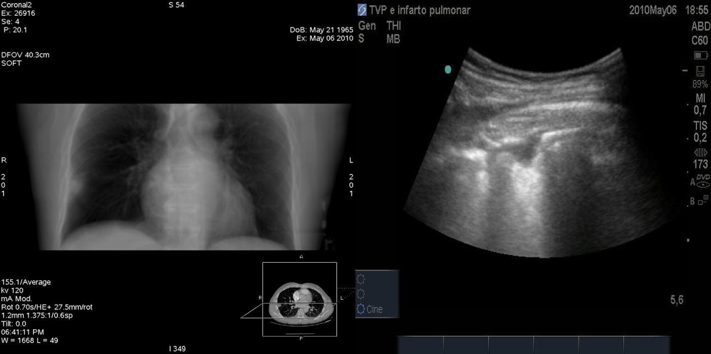 Diagnóstico ecográfico del infarto pulmonar en urgencias. A propósito ...