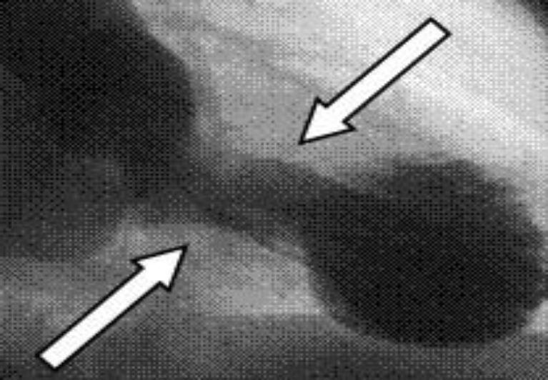 Síndrome de Tako-Tsubo. Discinesia transitoria del ventrículo izquierdo ...