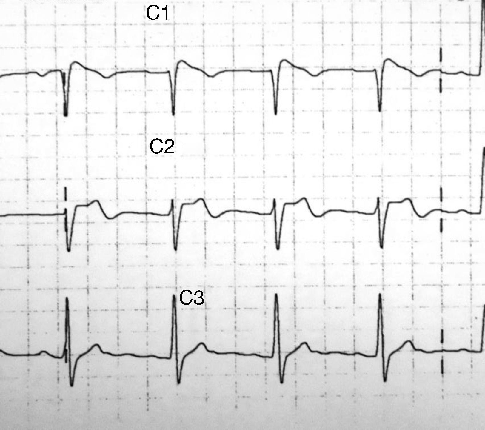 ¿Es el dolor torácico una rara manifestación de síndrome de Brugada ...