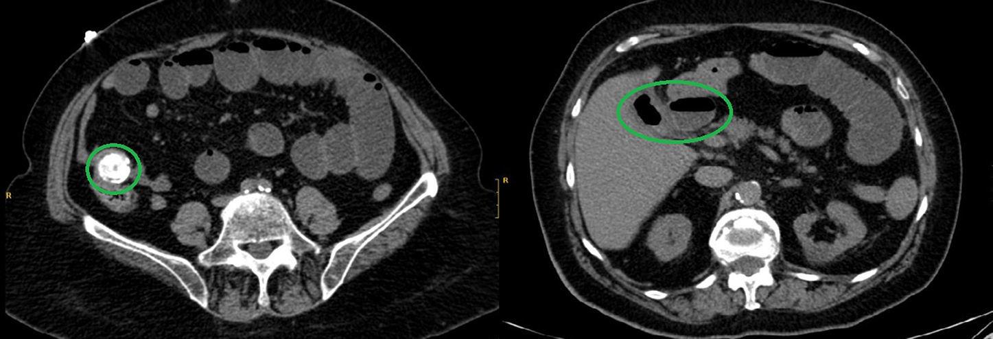 Causa infrecuente de obstrucción intestinal | Medicina de Familia. SEMERGEN